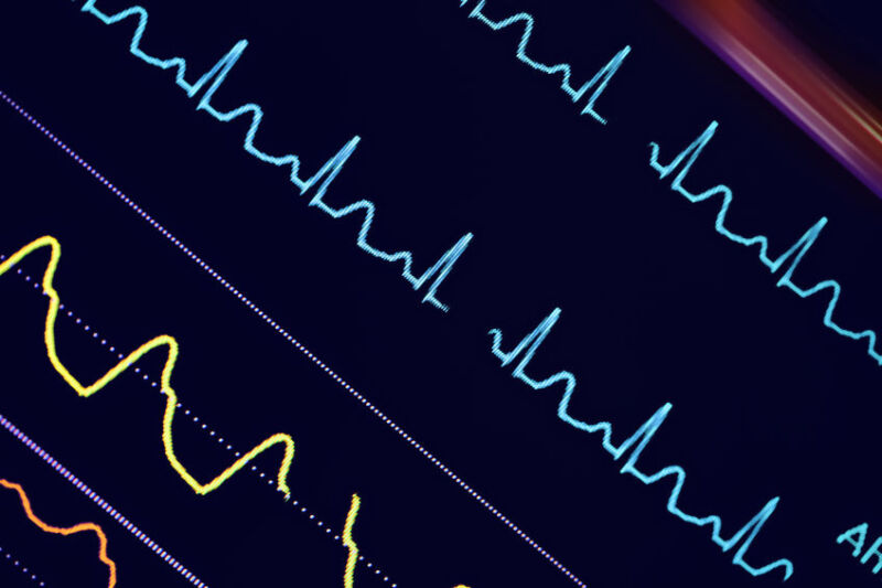 Restoring Heart Rhythm: Treatment Options For Arrhythmia - Sherman ...